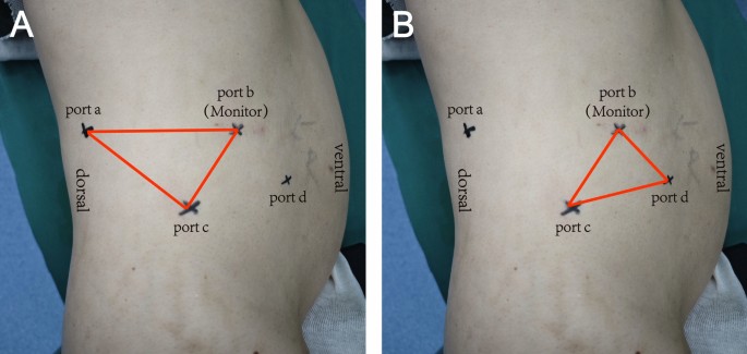 The surgical technique and efficacy of a novel pure ...