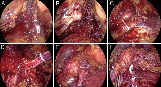 The surgical technique and efficacy of a novel pure ...