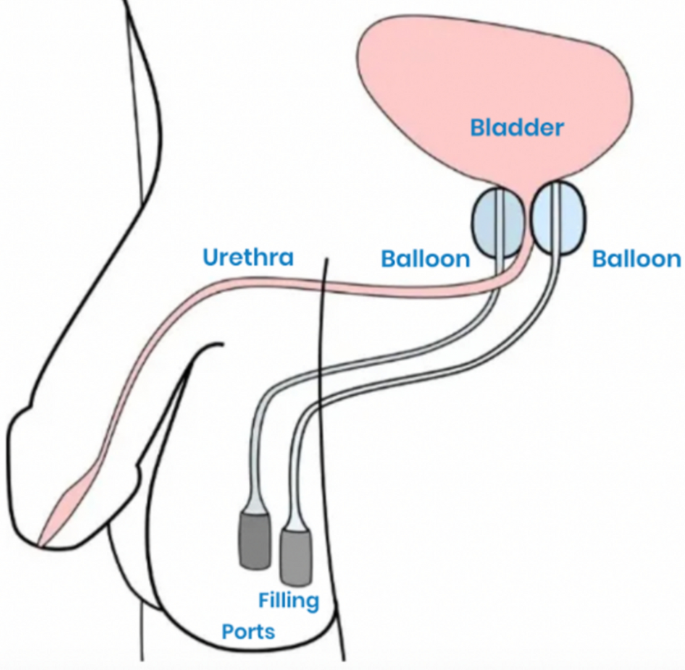 Adjustable dual-balloon therapy: quality of life after prostate ...