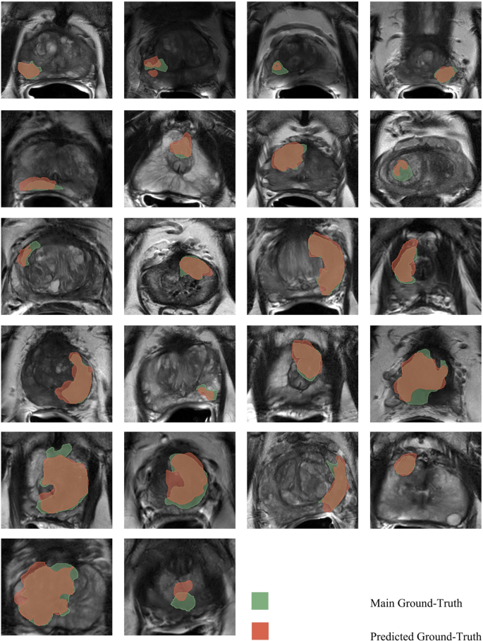 Exploring UNet-based models for prostate lesion segmentation from multi ...