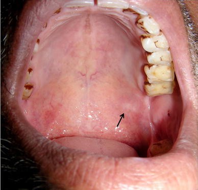 Unusual cause of palatal pain | SpringerLink