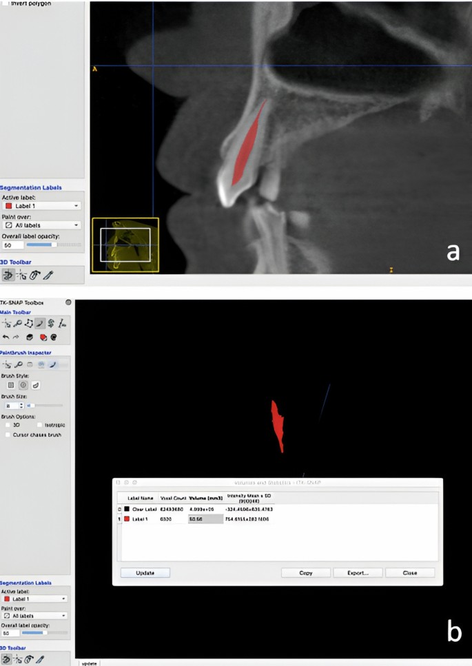 Age determination by measurement of pulp volume of canine teeth in ...