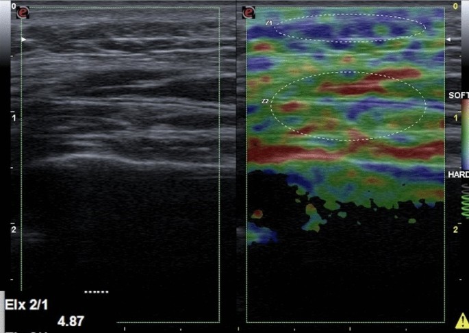 Immediate and short-term effect of manual therapy on masseter muscle ...