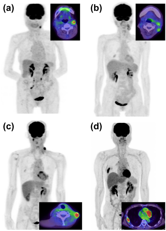 Treatment response assessment in resistant oral squamous cell carcinoma ...