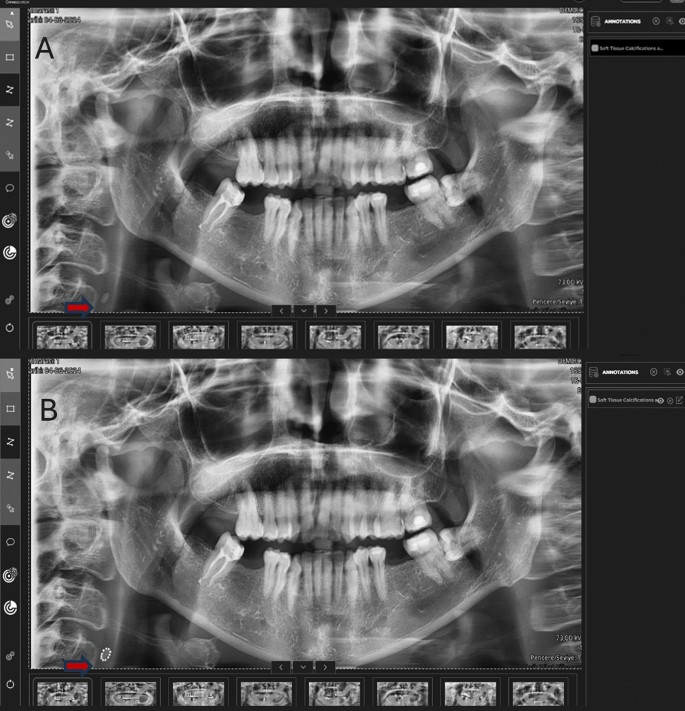 Evaluation of deep learning-based segmentation models for carotid ...