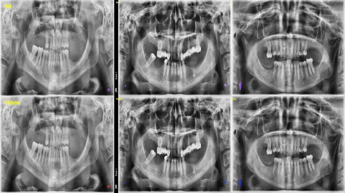 Evaluation of deep learning-based segmentation models for carotid ...