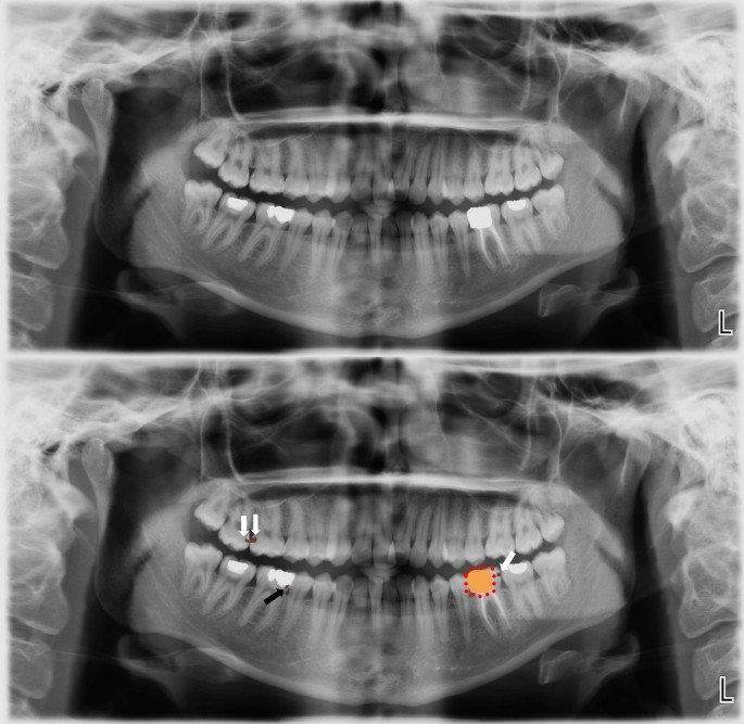 Assessment of posterior interproximal surfaces on bitewing and ...
