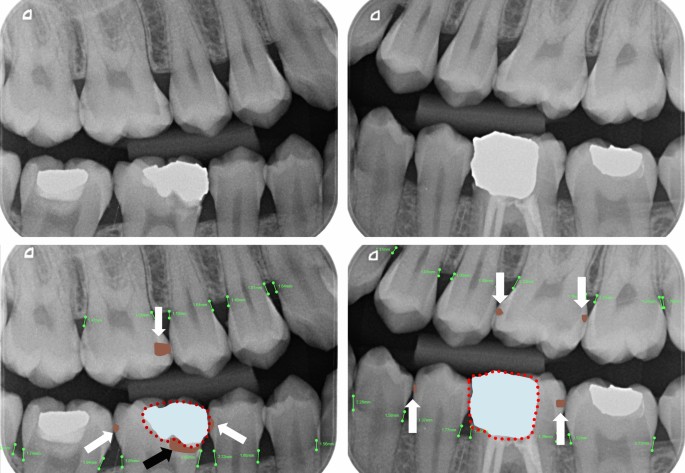 Assessment of posterior interproximal surfaces on bitewing and ...