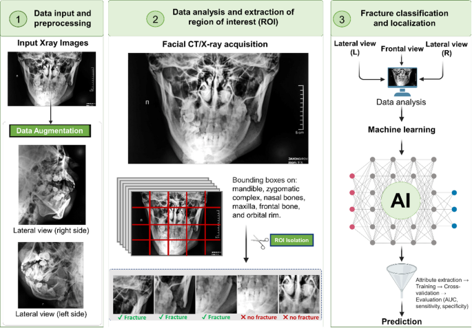 Diagnostic performance of artificial intelligence for facial fracture ...