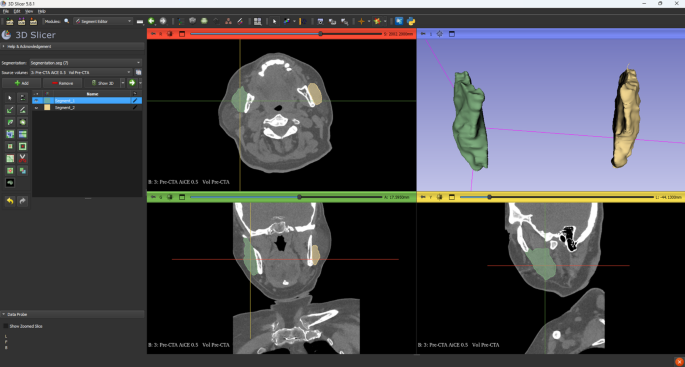 Retrospective pilot study on the correlation between masseter muscle ...