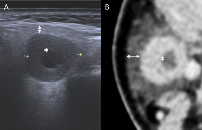 Minimum fascia-tumor distance of parotid tumors: a comparison of ...