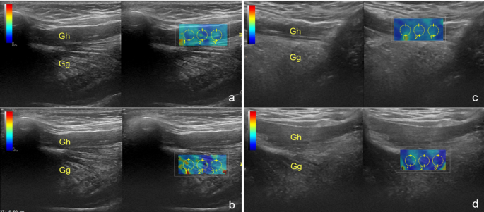 Ultrasonographic evaluation of genioglossus and geniohyoid muscles ...