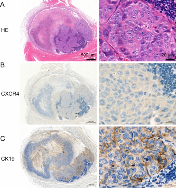 In Vivo Detection of Lymph Nodes Metastasis of ESCC Using CXCR4-Targeted Tracer [64Cu]Cu-NOTA ...