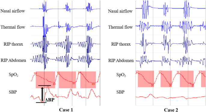 Relationship between sleep-breathing events induced nocturnal blood ...