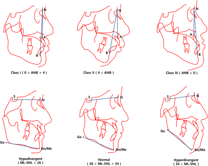 Cephalometric differences between patients with REM- and NREM ...