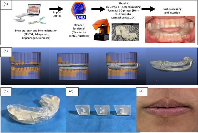 Effectiveness of a novel one visit 3D-printed titratable interlocking ...