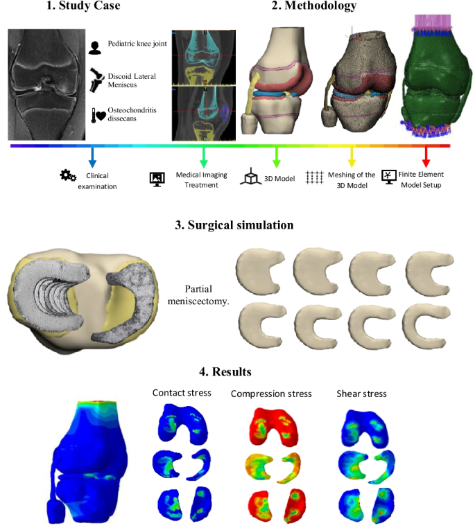 Biomechanical impact of discoid lateral meniscus and partial ...