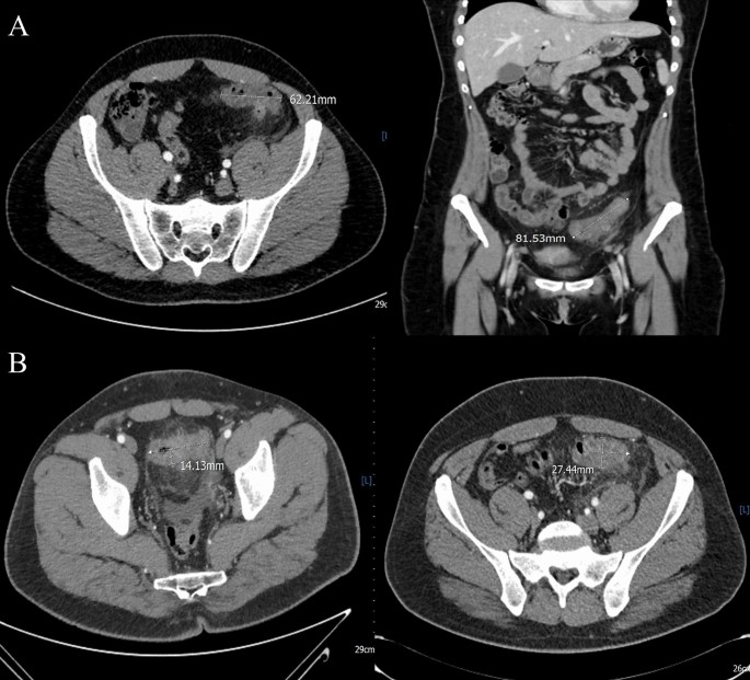 Acute diverticulitis: beyond the diagnosis: predictive role of CT in ...
