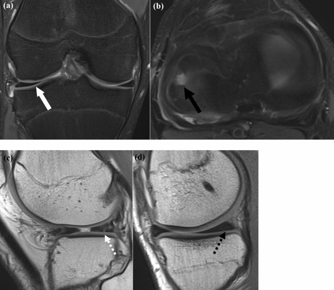 MRI diagnostic performance and strategies for identifying retears in ...