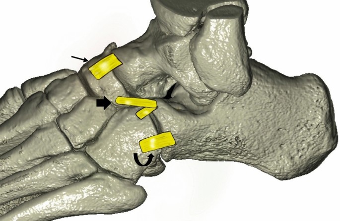 The missed chapter on midfoot: Chopart injuries | La radiologia medica