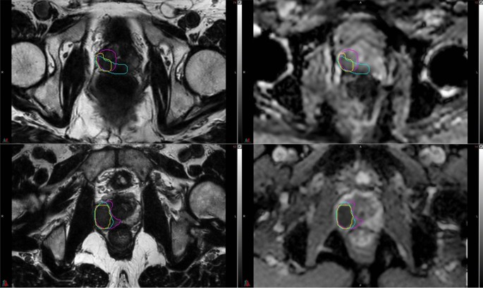 Factors of interobserver variability in prostate tumor MRI delineation ...