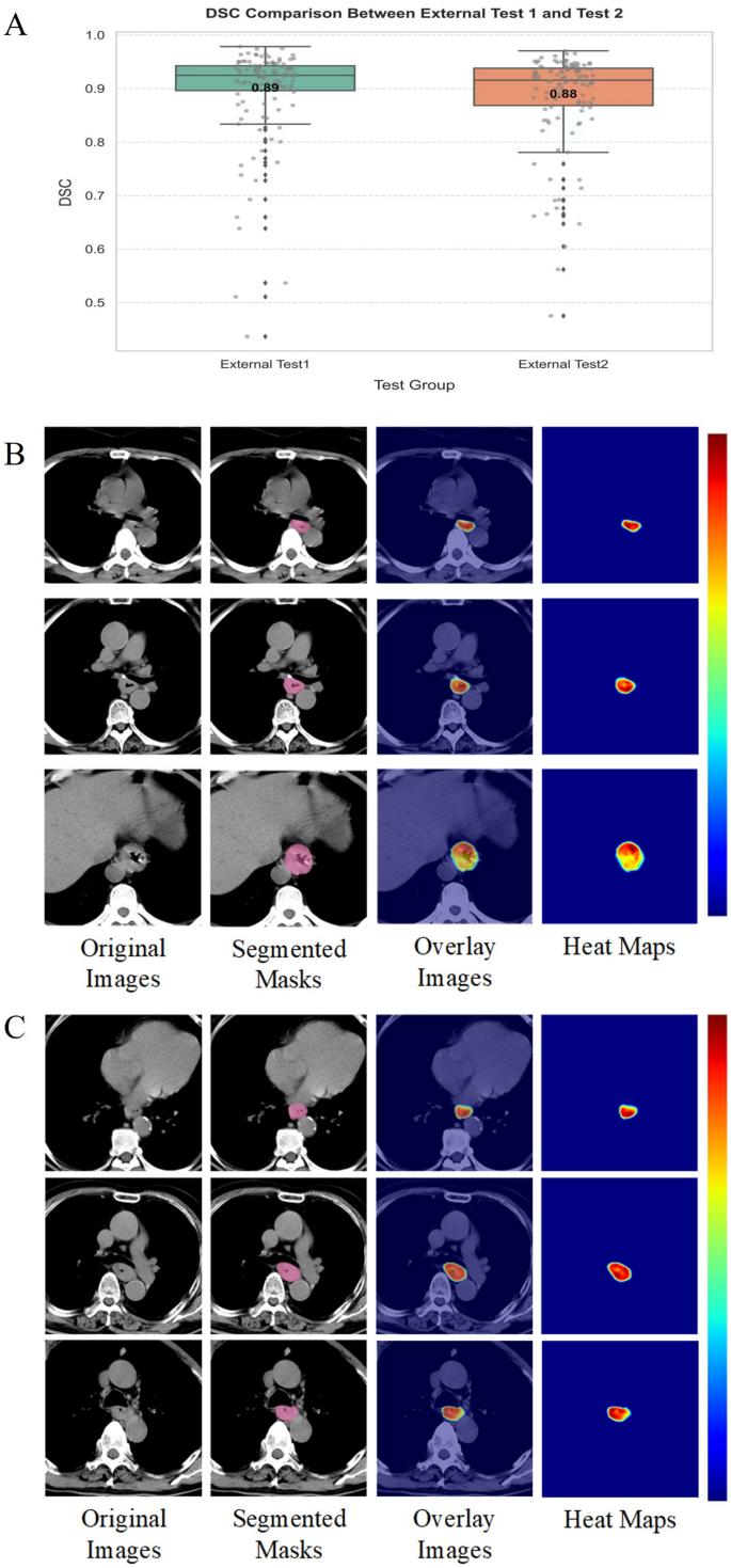 RegGAN-based contrast-free CT enhances esophageal cancer assessment: multicenter validation of ...