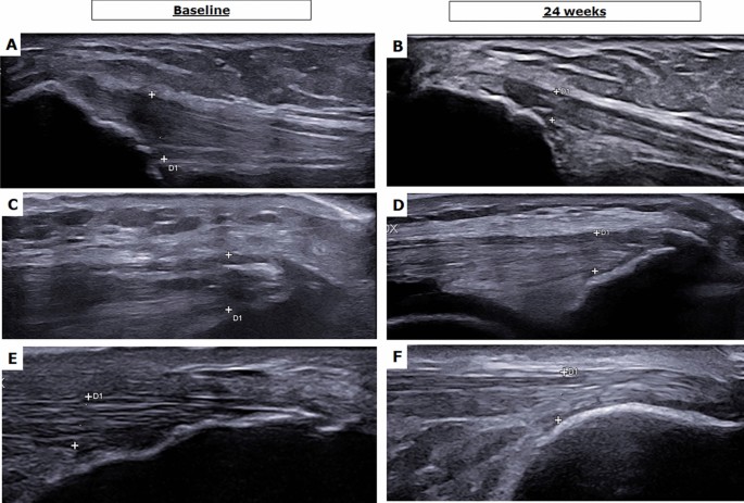 The evaluation of effectiveness of IL-17 and IL-23 inhibitors on nail ...