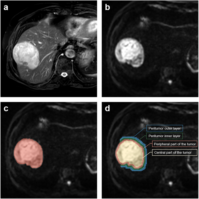 Advanced diffusion-weighted imaging of invasive tumor front for ...