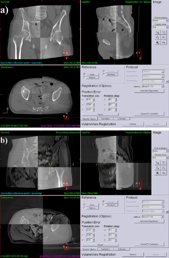 Step-by-step assessment of MRI-only workflow in pelvic radiotherapy ...