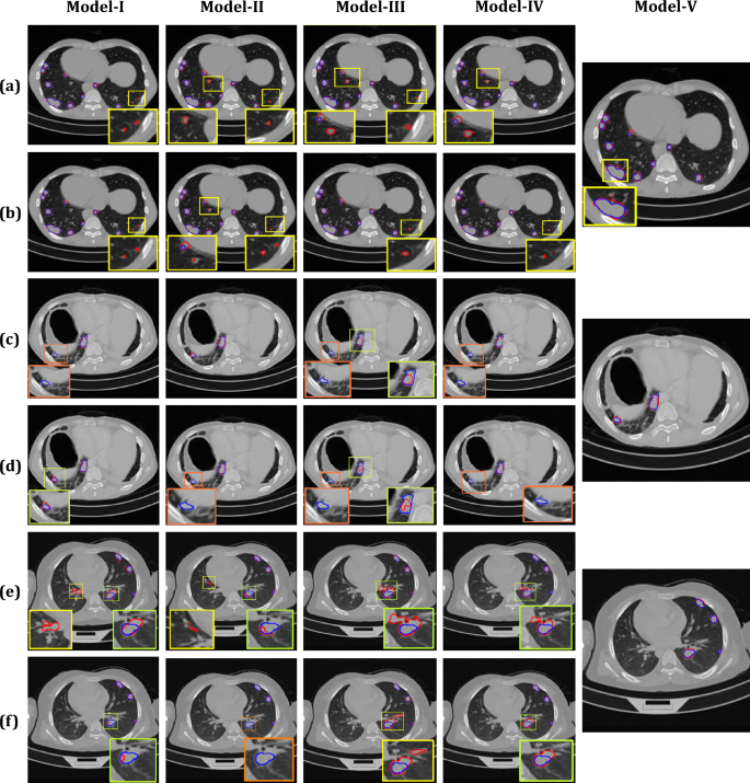 Improving lung nodule segmentation in thoracic CT scans through the ensemble of 3D U-Net models ...