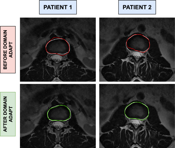 Domain adaptation using AdaBN and AdaIN for high-resolution IVD mesh ...
