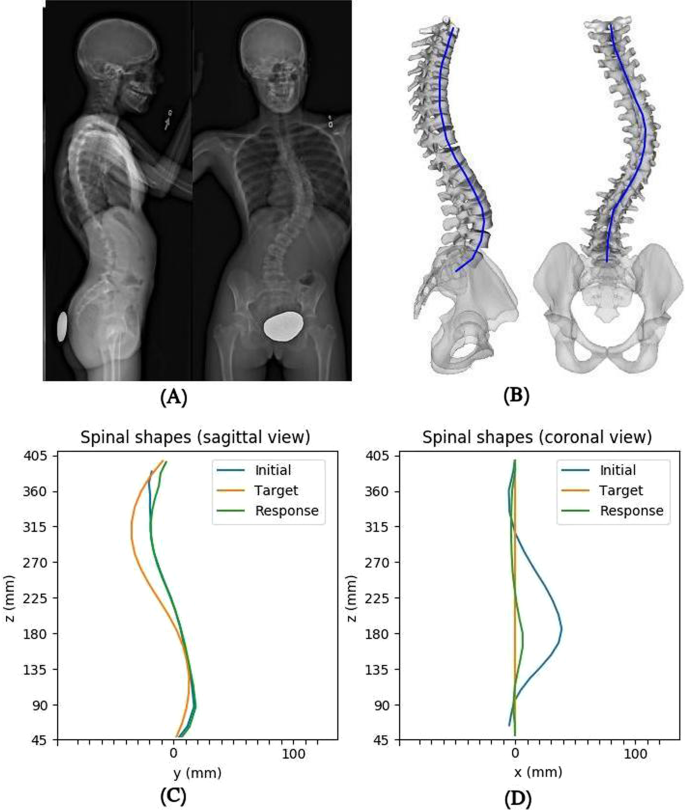 Real-time prediction of postoperative spinal shape with machine ...