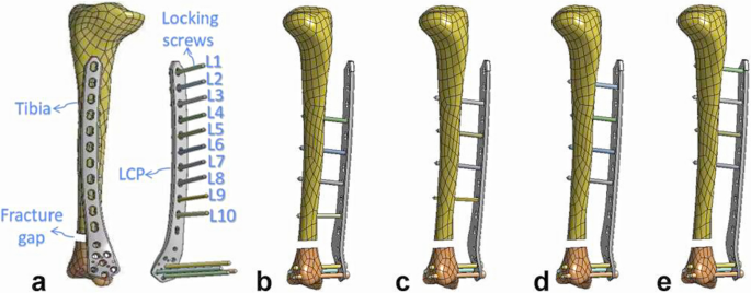 Effect of Screw Distribution on Stability and Interfragmentary Strain ...