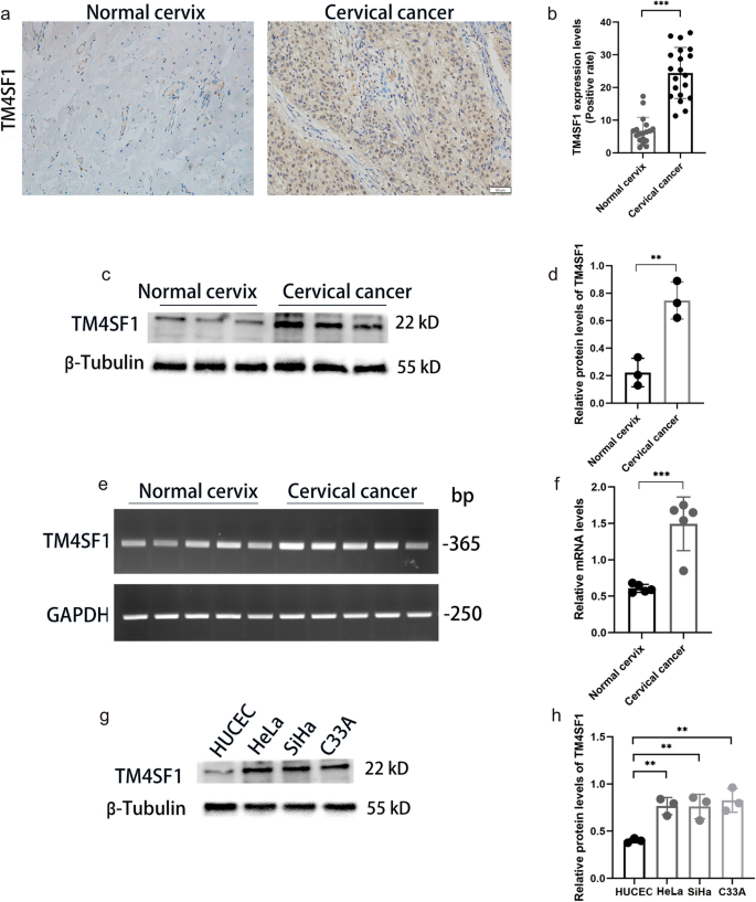 TM4SF1 as a Prognostic Biomarker and Therapeutic Target in Cervical ...