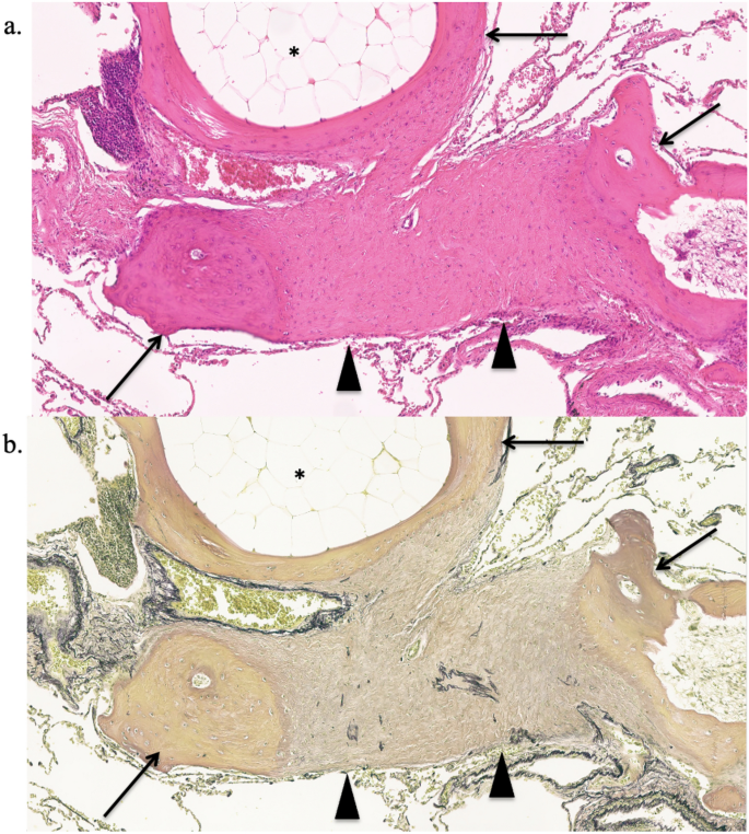 Idiopathic dendriform pulmonary ossification as the phenotype of ...