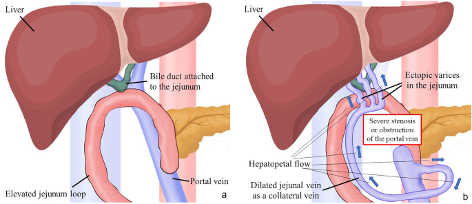 Embolization with or without portal vein stenting for bleeding ectopic ...
