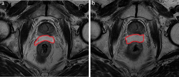 Unexpected change in hydrogel spacer volume during external-beam ...