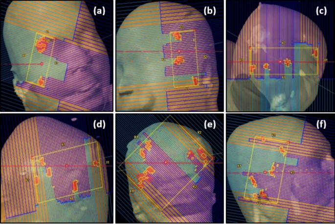 Optimizing normal tissue objectives (NTO) in eclipse treatment planning ...
