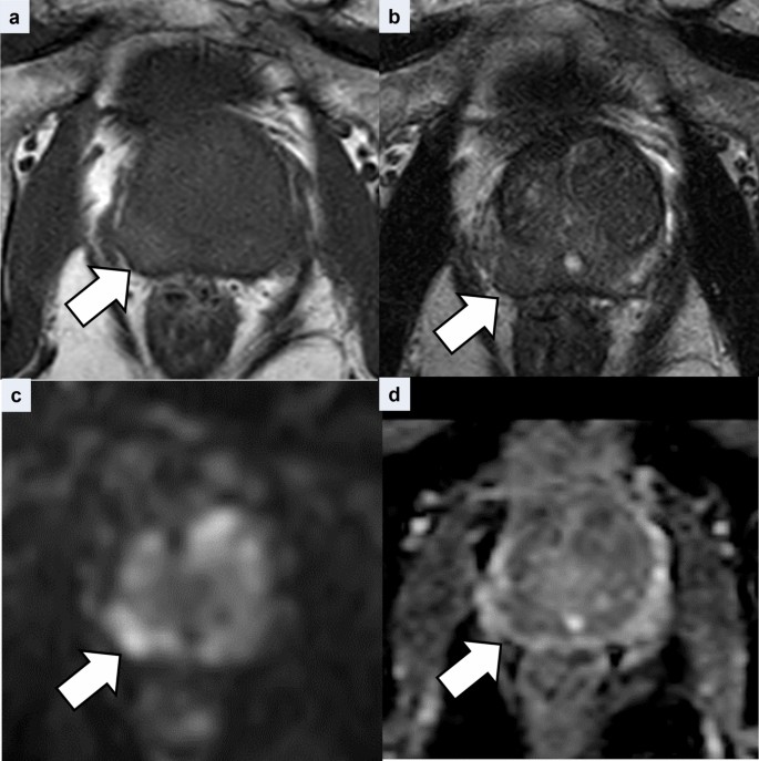 MRI findings of granulomatous prostatitis induced by intravesical ...