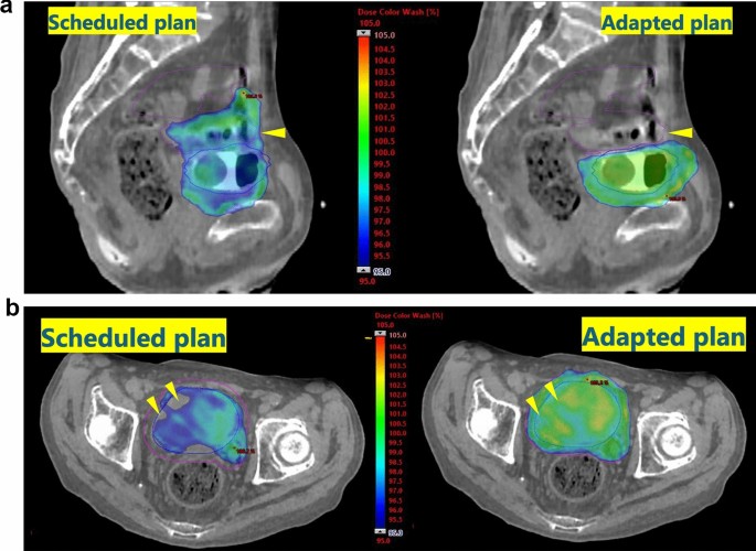 Online adaptive radiation therapy for muscle-invasive bladder cancer ...