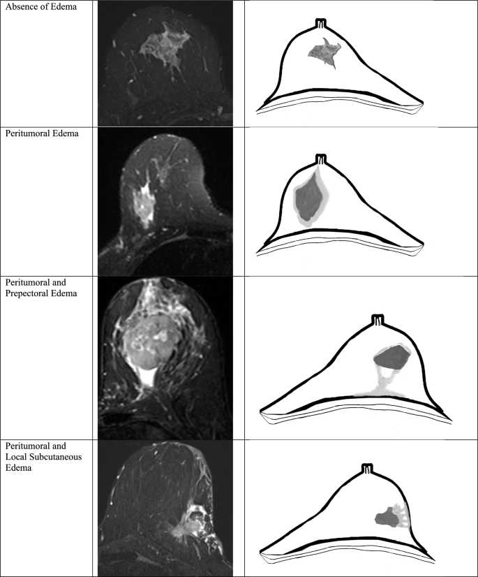 Role of breast edema in predicting complete response to neoadjuvant ...