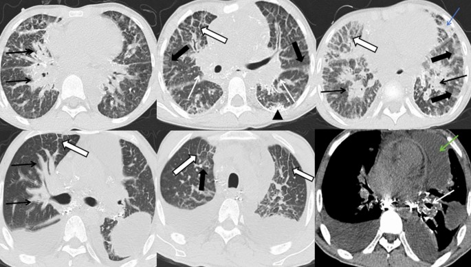 Comparative analysis of clinical and CT manifestations between complex ...