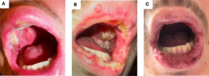Adult Reactive Infectious Mucocutaneous Eruption (RIME) from Concurrent ...