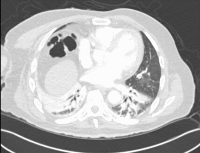 Respiratory-Onset Amyotrophic Lateral Sclerosis (ALS): A Rare Initial ...