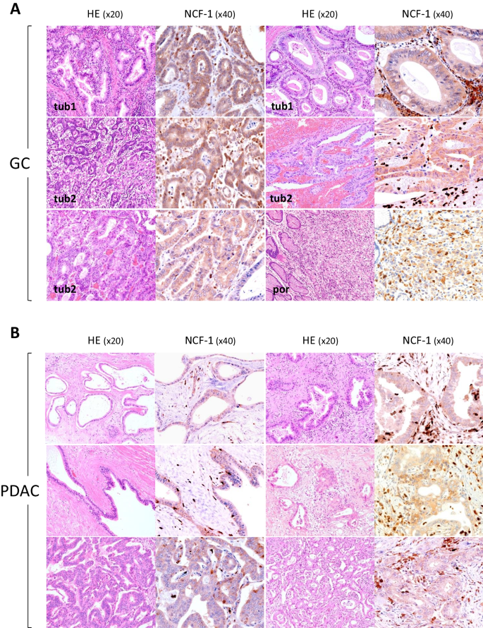 NCF-1 plays a pivotal role in the survival of adenocarcinoma cells of ...