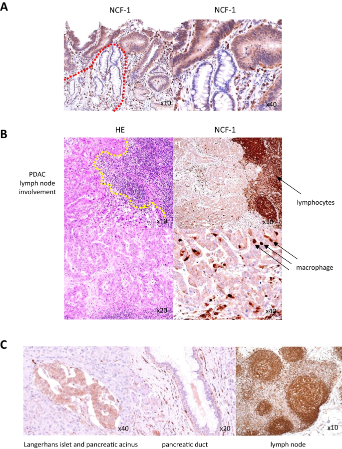 NCF-1 plays a pivotal role in the survival of adenocarcinoma cells of pancreatic and gastric ...