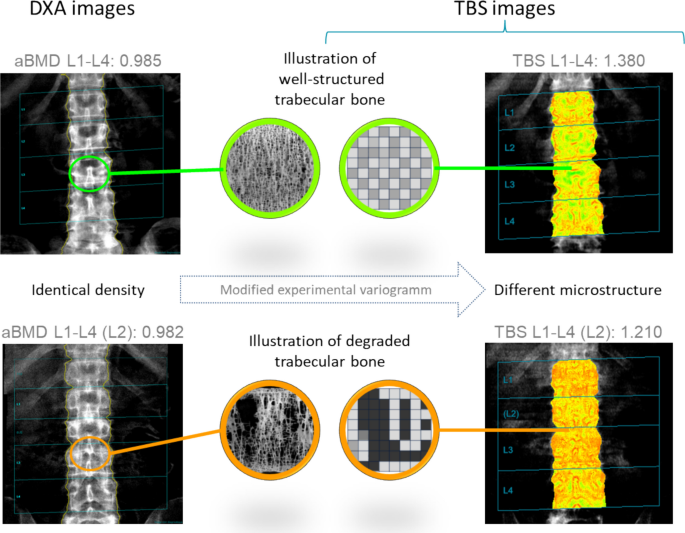 The effects of spaceflight countermeasures on trabecular bone score ...