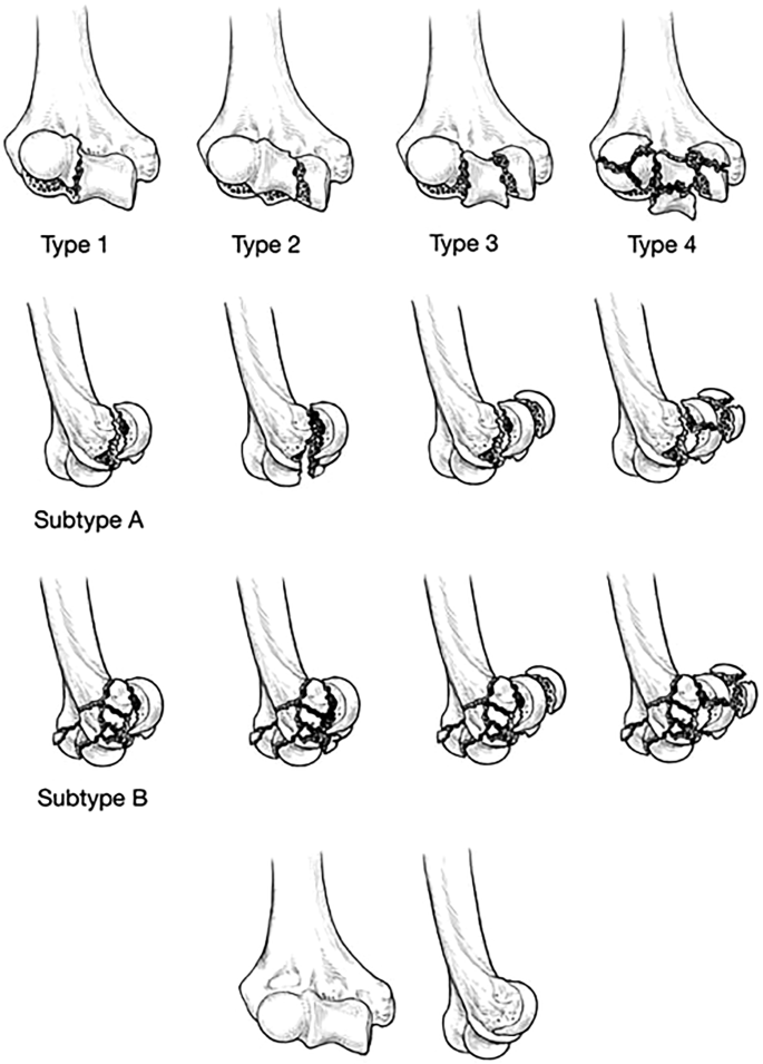 Coronal shear fractures of the distal humerus | Obere Extremität