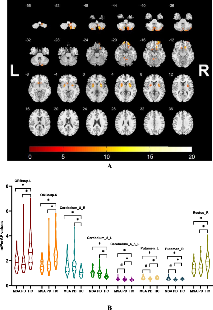 Differentiating patterns of neuro-circuitry abnormalities in tremor ...