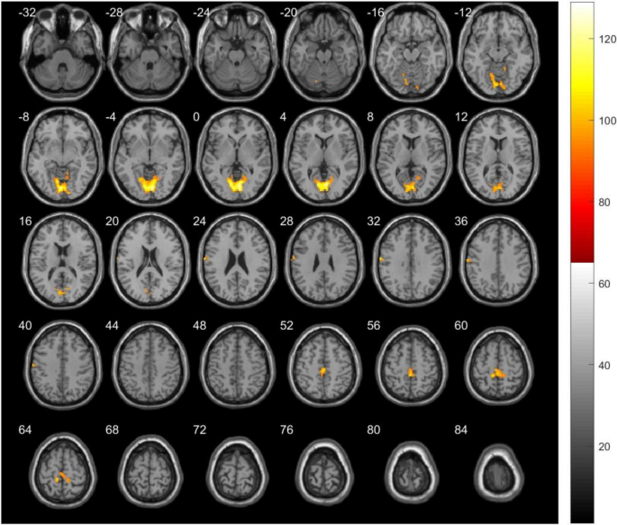 Reduced local functional connectivity correlates with atypical ...